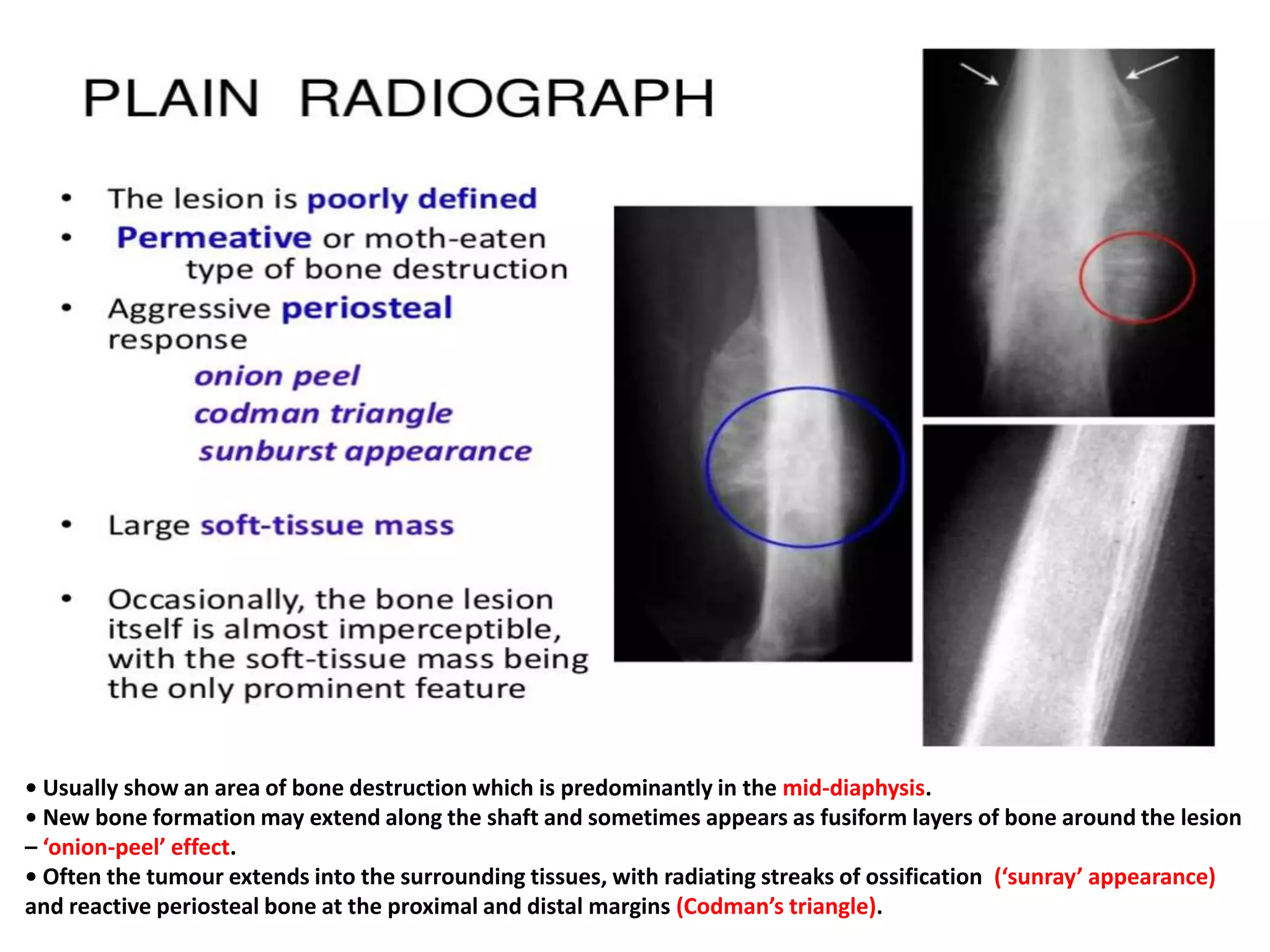 Ewing's sarcoma | PPTX