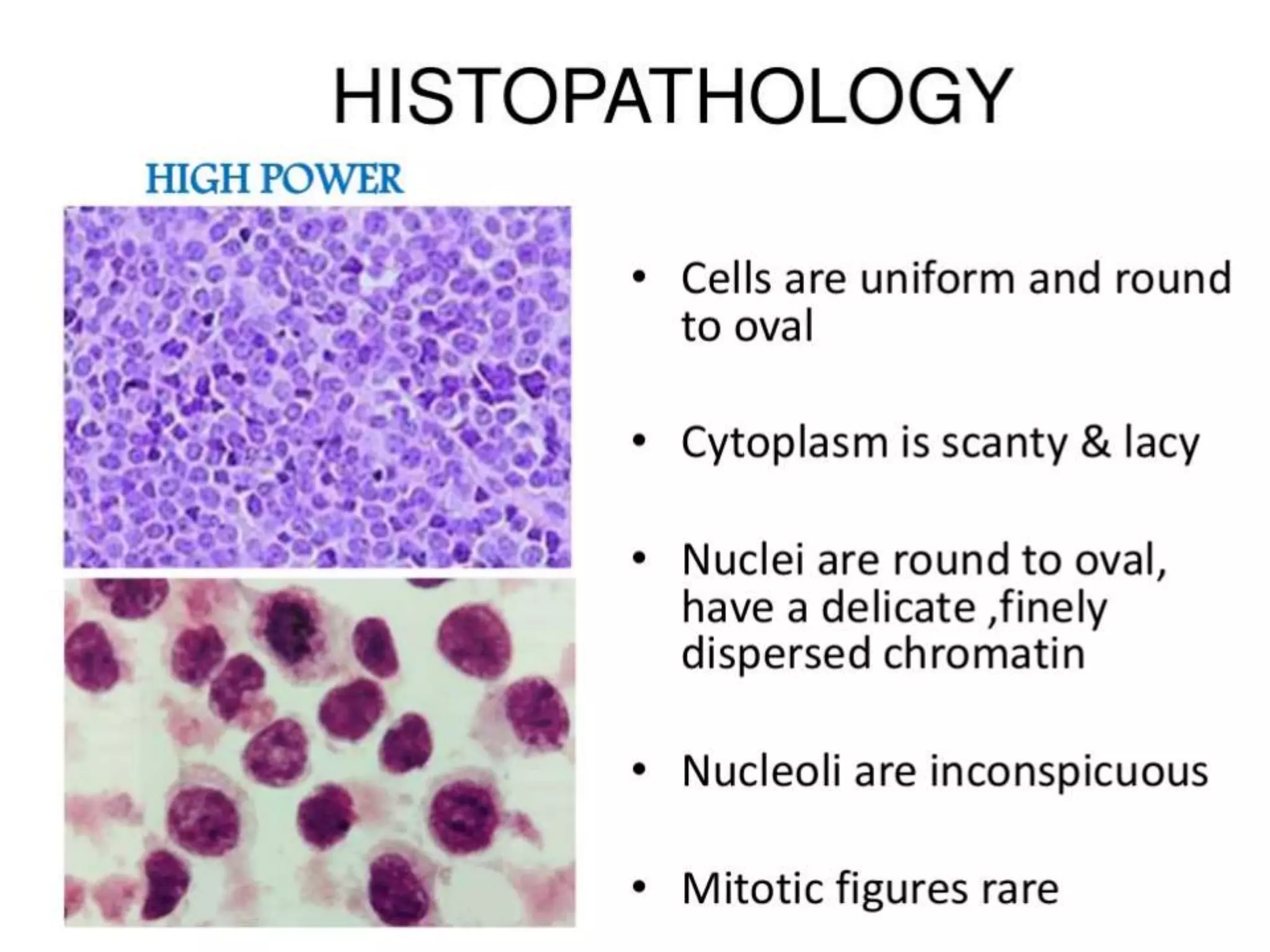 Ewing Sarcoma Histology Diagram