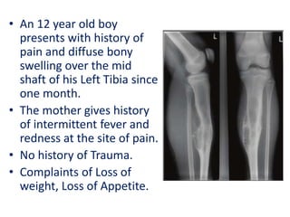 Ewing's sarcoma | PPTX