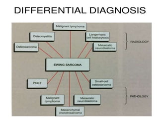 Ewing's sarcoma | PPTX