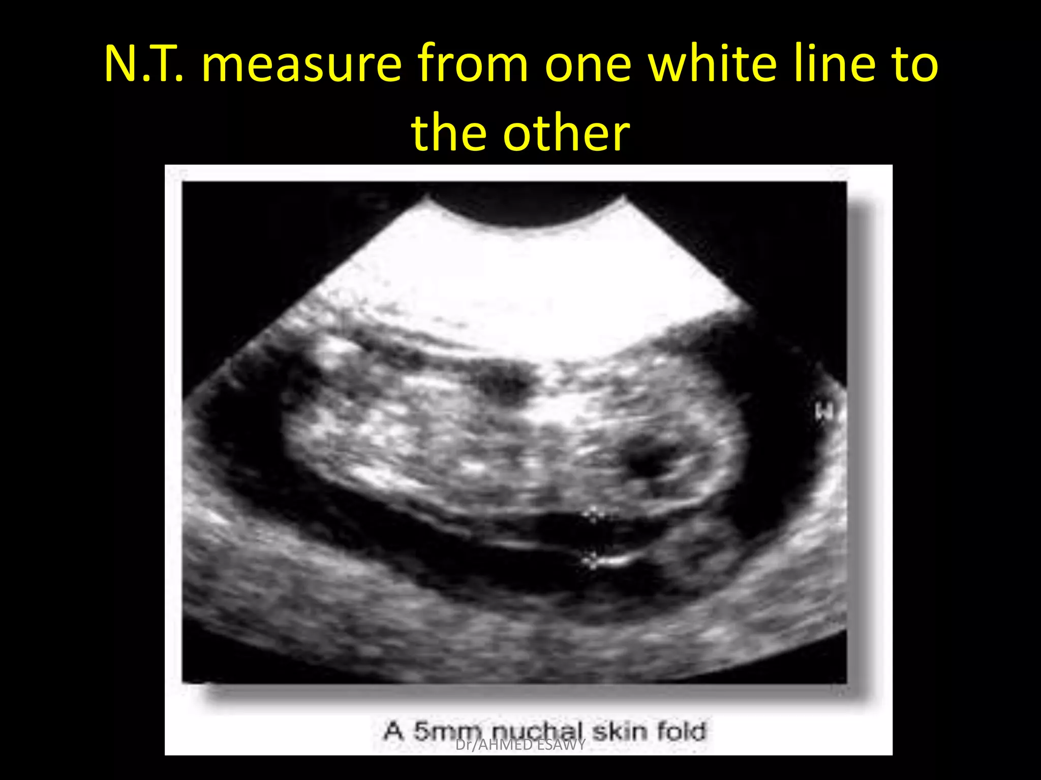 1-fetal genetic ultrasound Dr Ahmed Esawy | PDF