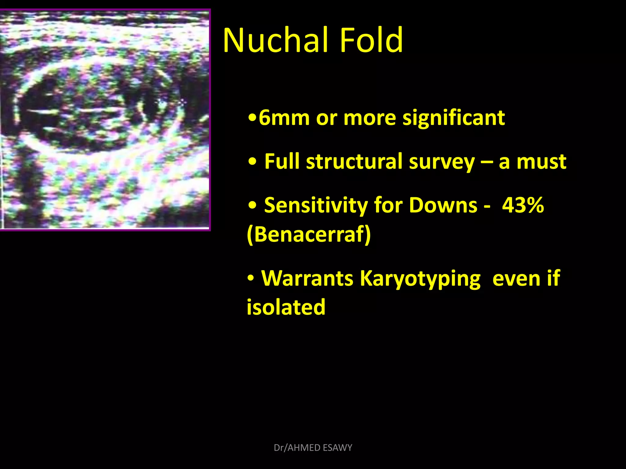 1-fetal genetic ultrasound Dr Ahmed Esawy | PDF