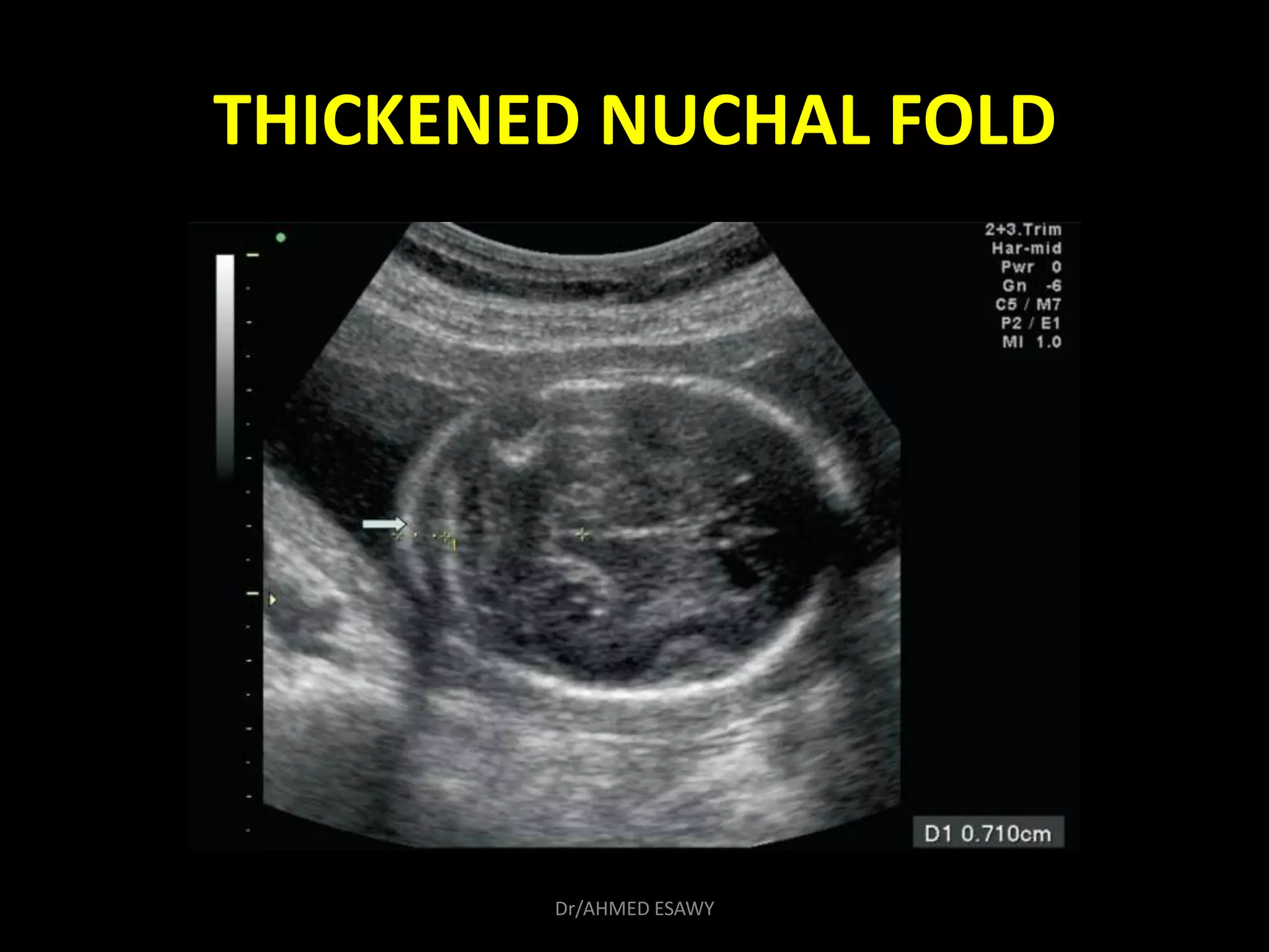 1-fetal genetic ultrasound Dr Ahmed Esawy | PDF