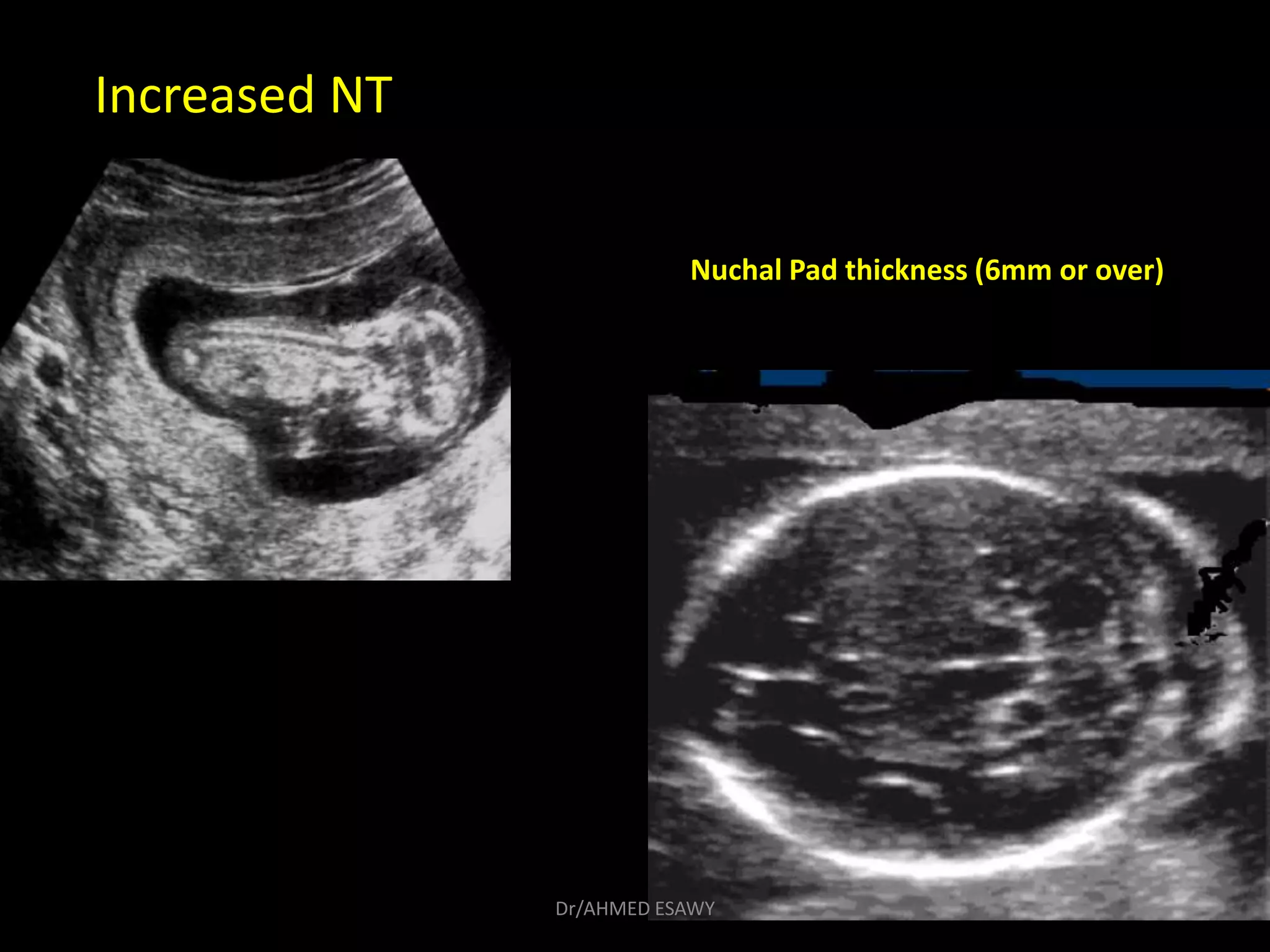 1-fetal genetic ultrasound Dr Ahmed Esawy | PDF