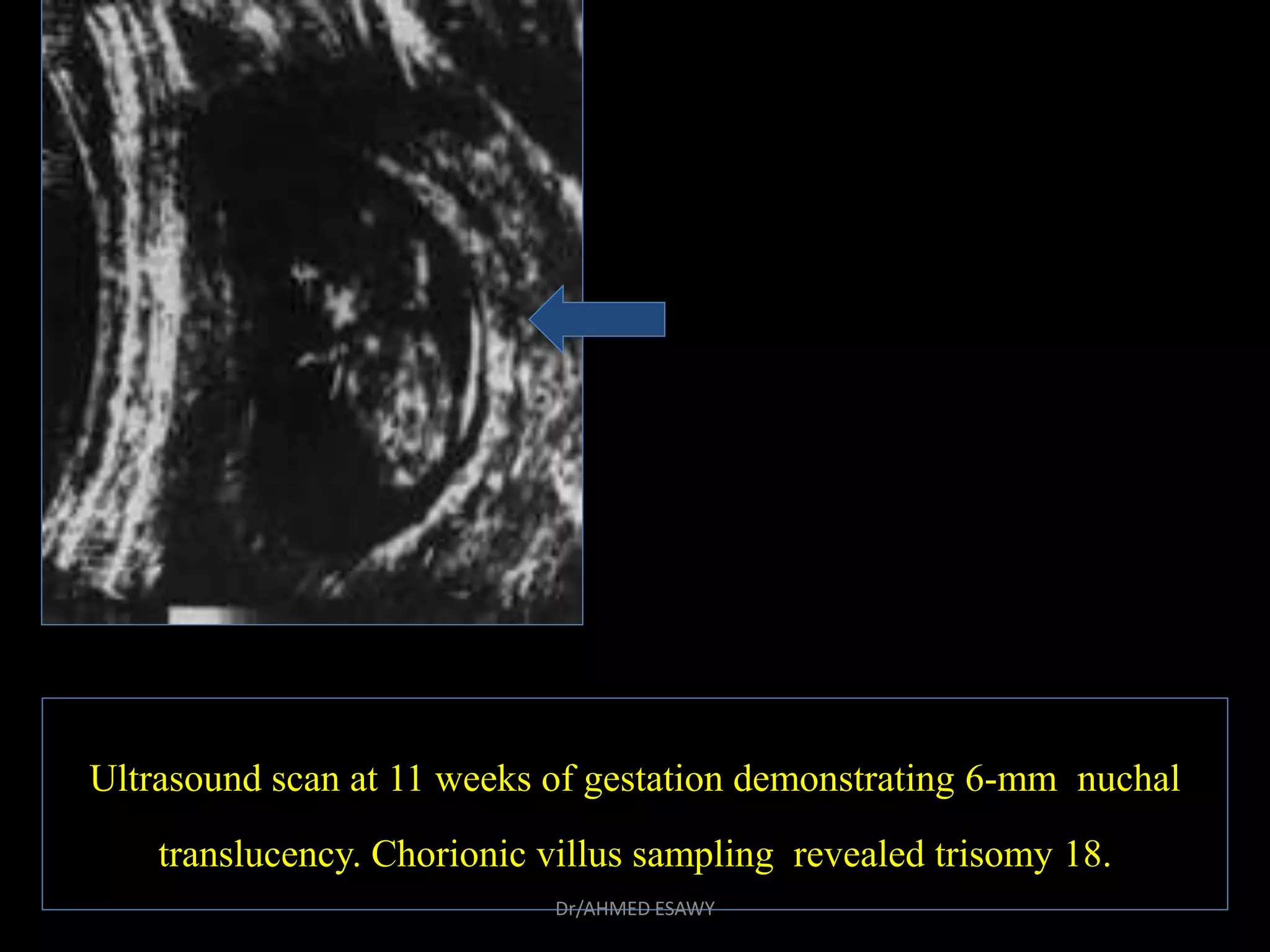 1-fetal genetic ultrasound Dr Ahmed Esawy | PDF