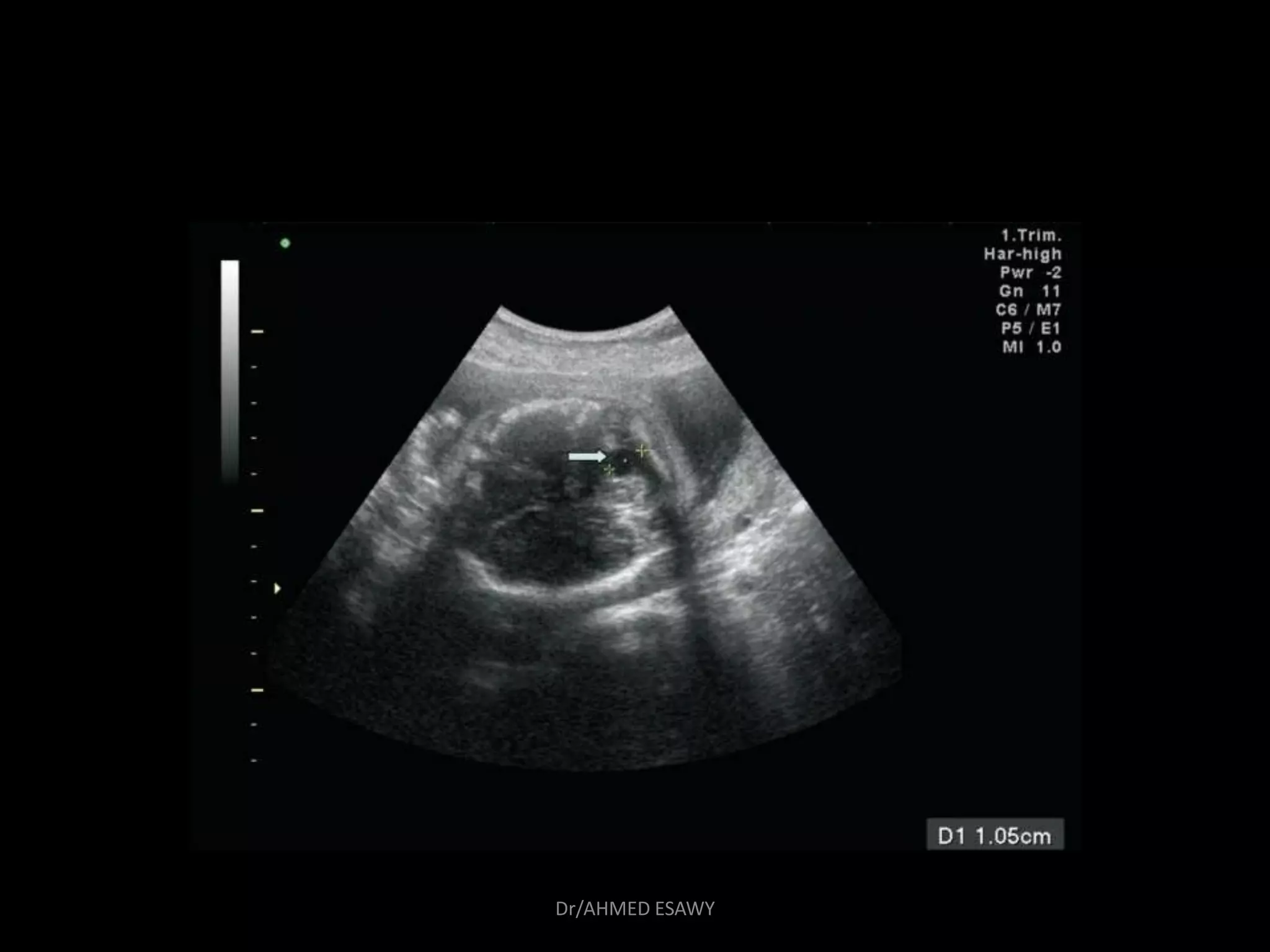 1-fetal genetic ultrasound Dr Ahmed Esawy | PDF