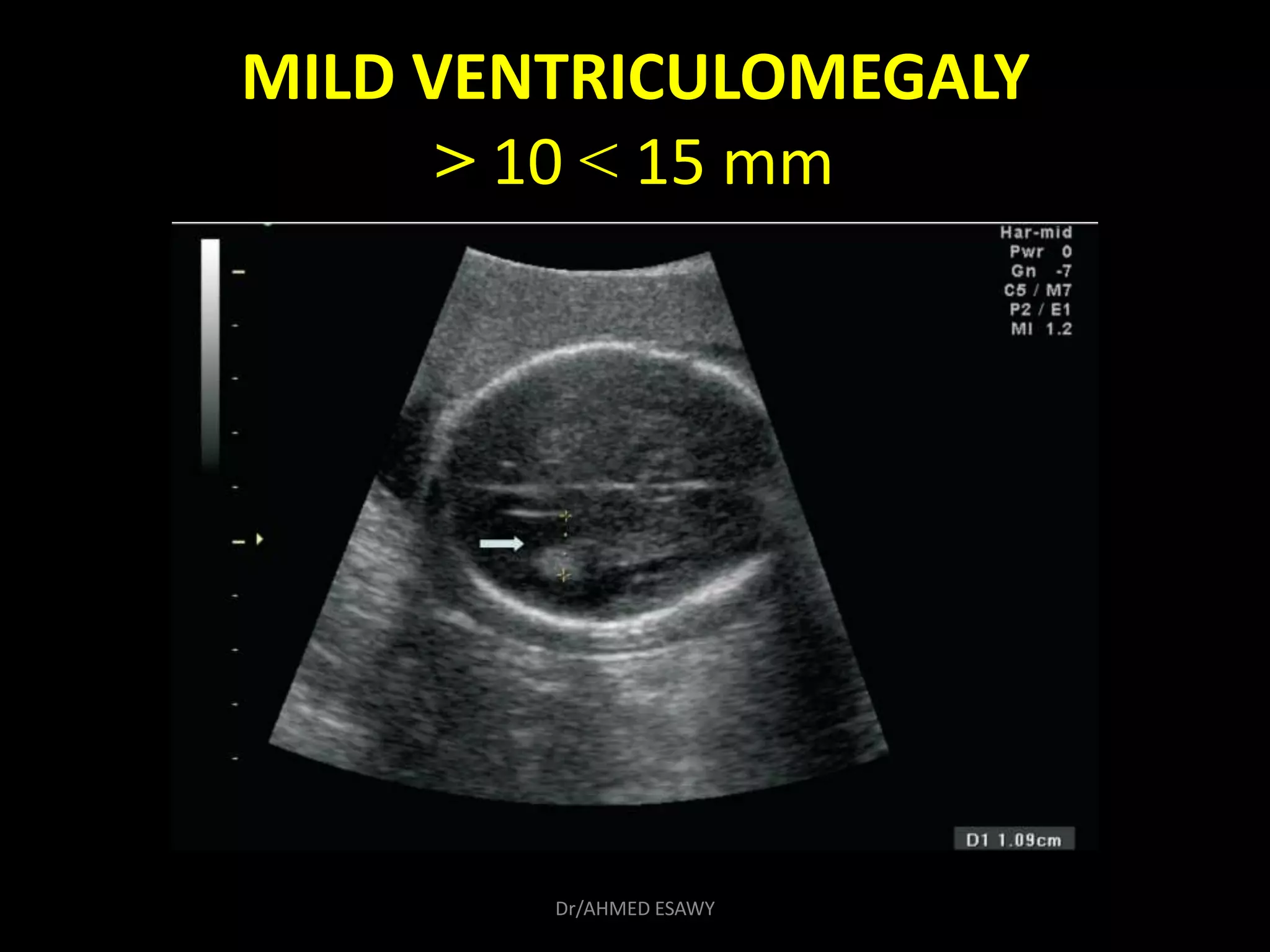 1-fetal genetic ultrasound Dr Ahmed Esawy | PDF
