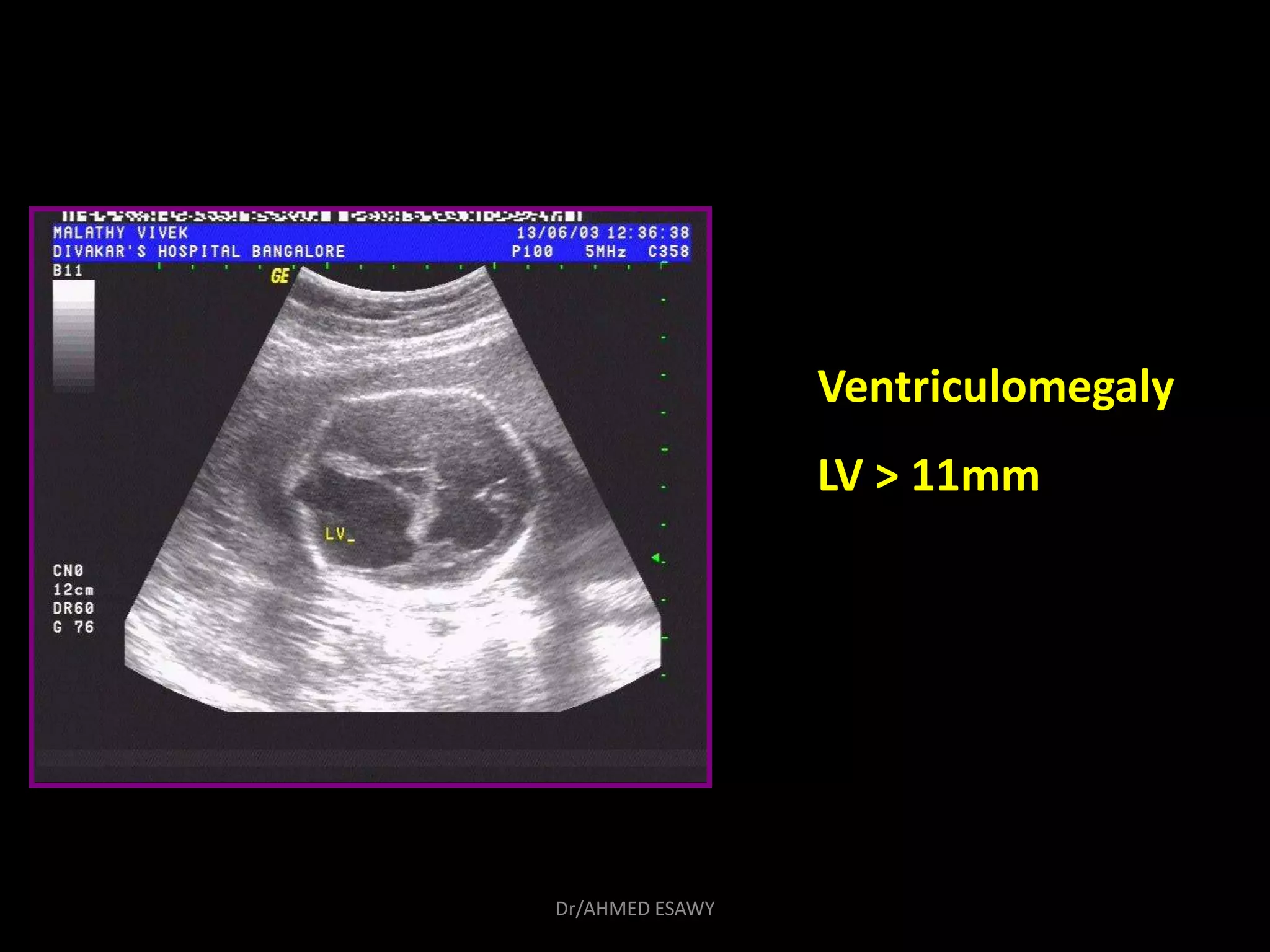 1-fetal genetic ultrasound Dr Ahmed Esawy | PDF