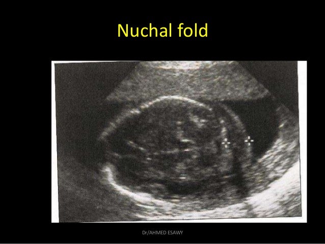 1-fetal genetic ultrasound Dr Ahmed Esawy