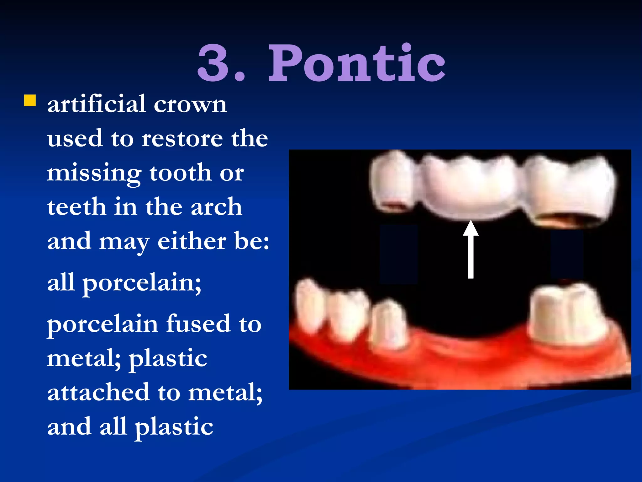 1. fixed partial denture finals1 | PPT