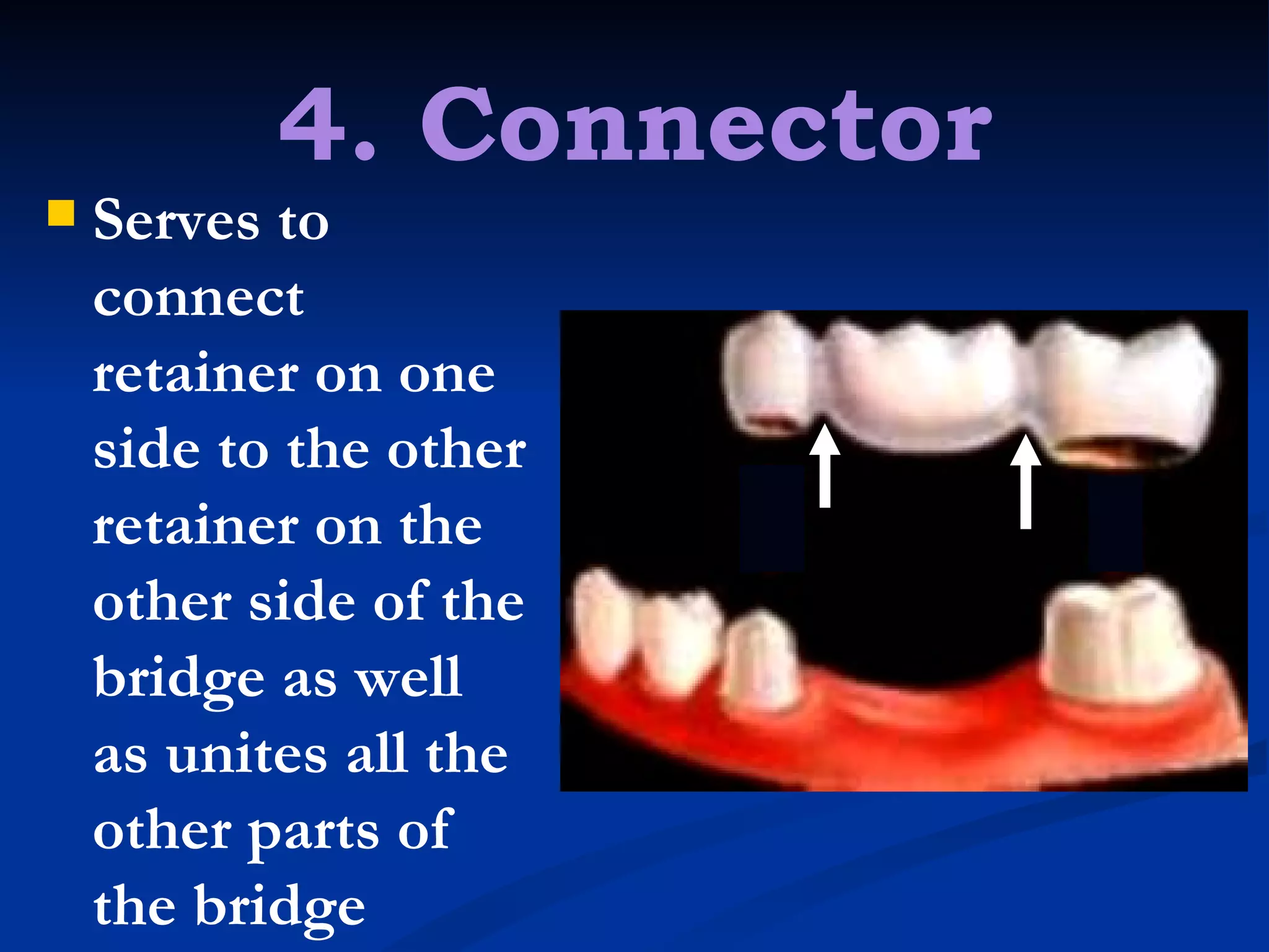 1. fixed partial denture finals1 | PPT