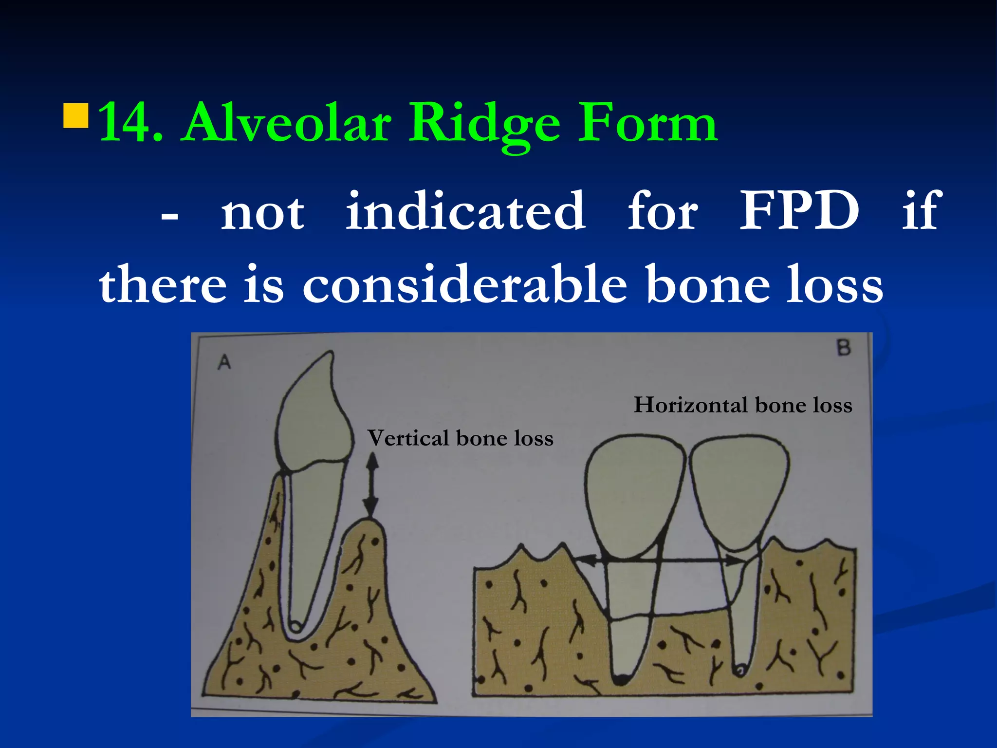 1. fixed partial denture finals1 | PPT
