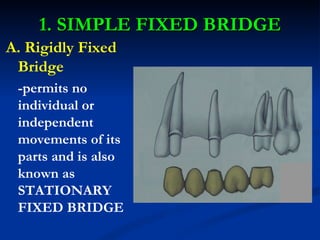 1. fixed partial denture finals1 | PPT