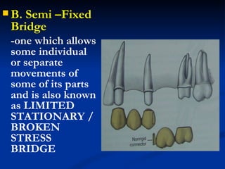 1. fixed partial denture finals1 | PPT