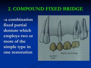 1. fixed partial denture finals1 | PPT