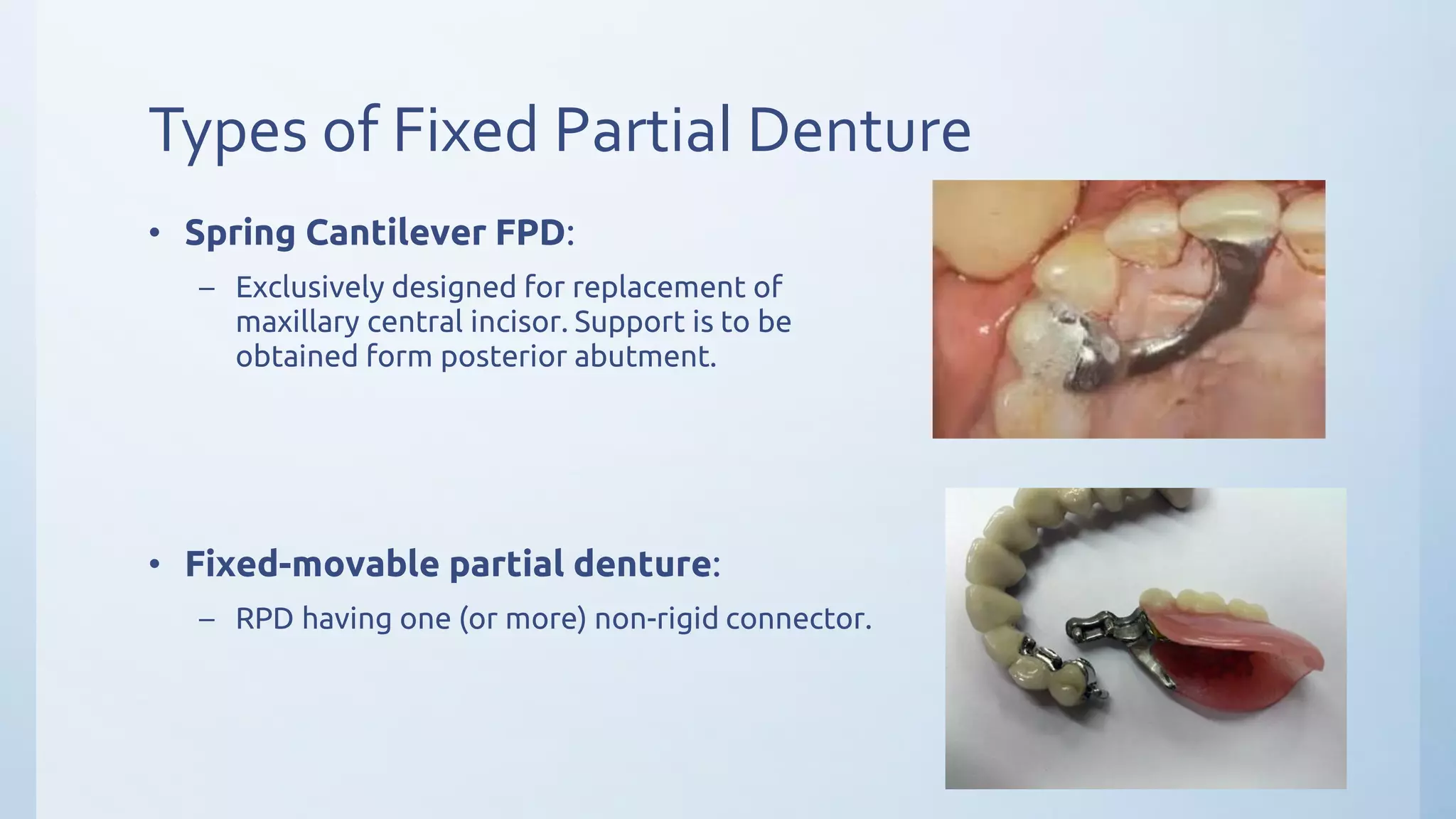 1/2 Fixed Partial Dentures (FPD) Introduction & Basics @ Faryal | PDF