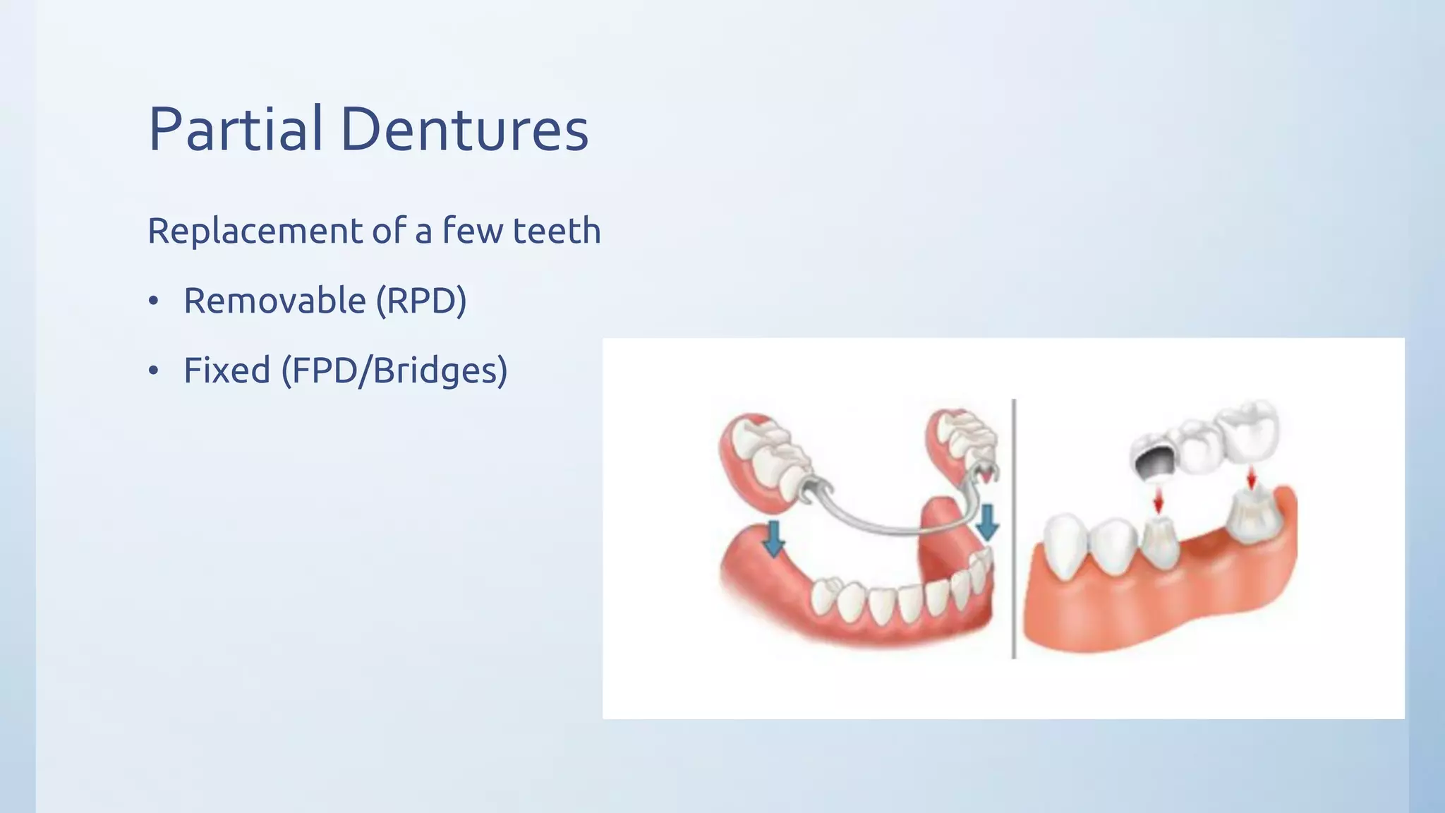 1/2 Fixed Partial Dentures (FPD) Introduction & Basics @ Faryal | PDF
