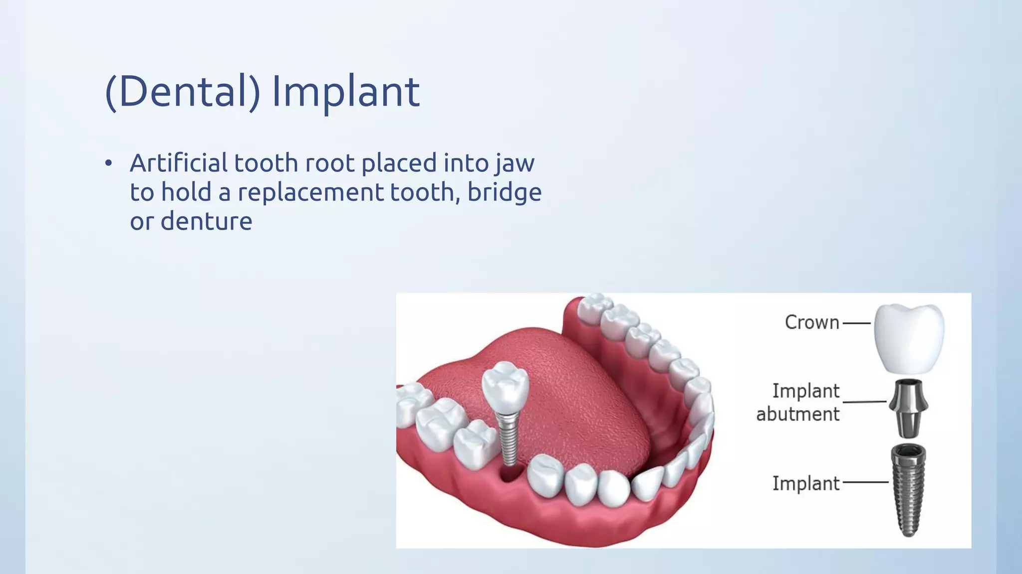 1/2 Fixed Partial Dentures (FPD) Introduction & Basics @ Faryal | PDF