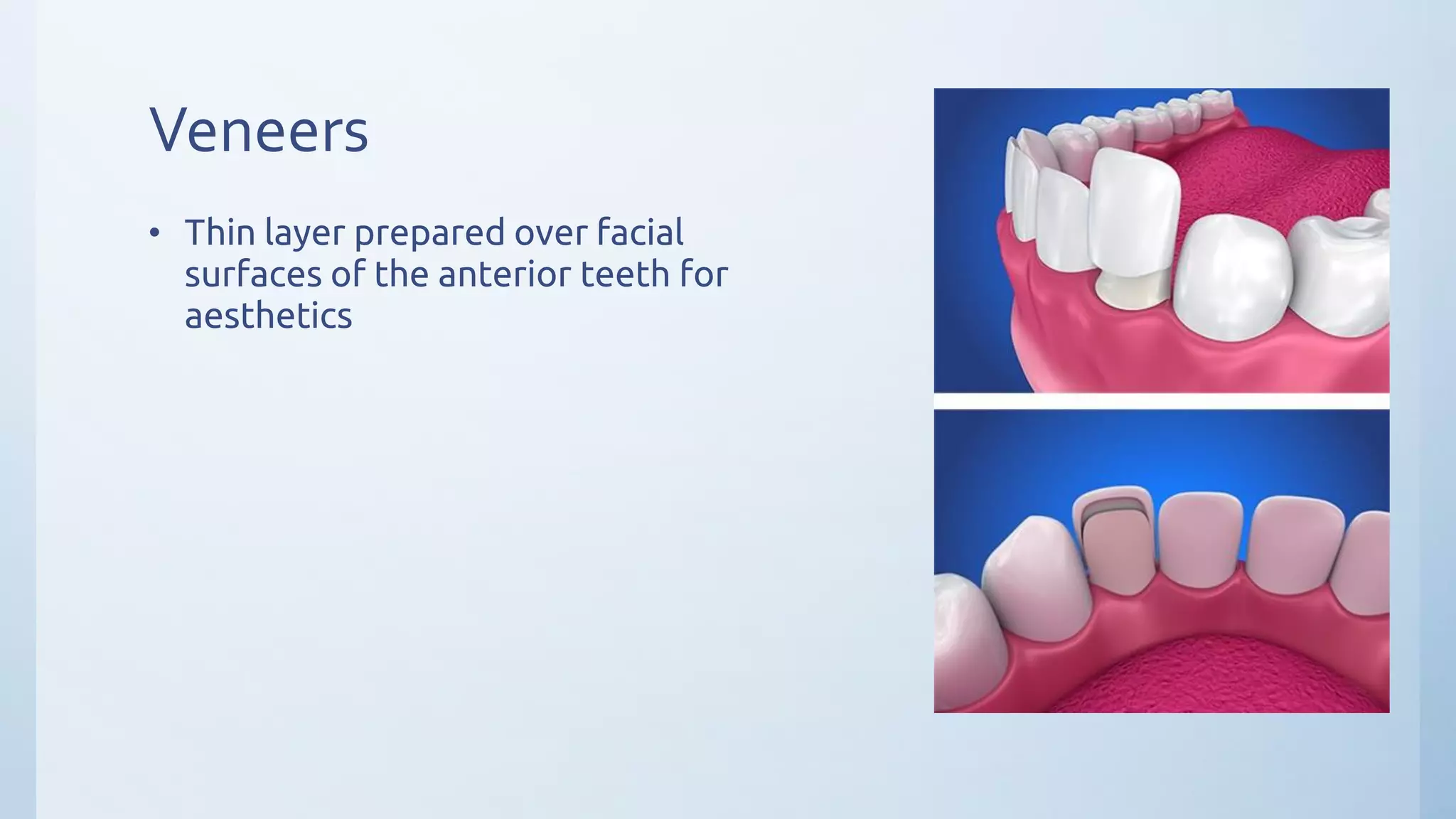 1/2 Fixed Partial Dentures (FPD) Introduction & Basics @ Faryal | PDF