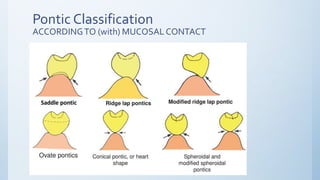 1/2 Fixed Partial Dentures (FPD) Introduction & Basics @ Faryal | PDF