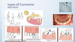 1/2 Fixed Partial Dentures (FPD) Introduction & Basics @ Faryal | PDF