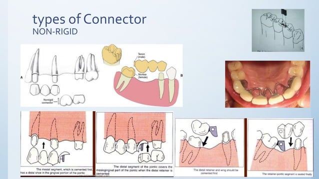 1/2 Fixed Partial Dentures (FPD) Introduction & Basics @ Faryal | PDF