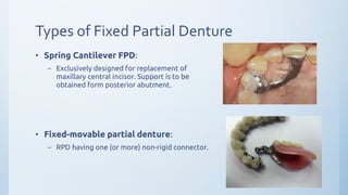 1/2 Fixed Partial Dentures (FPD) Introduction & Basics @ Faryal | PDF