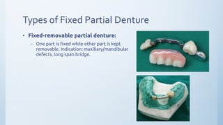 1/2 Fixed Partial Dentures (FPD) Introduction & Basics @ Faryal | PDF
