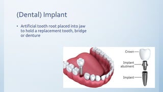 1/2 Fixed Partial Dentures (FPD) Introduction & Basics @ Faryal | PDF