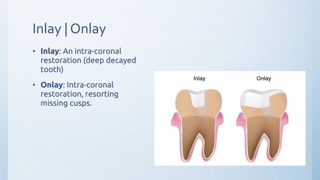 1/2 Fixed Partial Dentures (FPD) Introduction & Basics @ Faryal | PPT