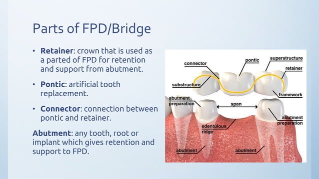 1/2 Fixed Partial Dentures (FPD) Introduction & Basics @ Faryal | PDF