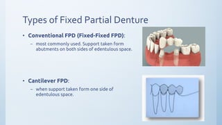 Fixed Partial Denture Indications, Contraindications, Advantages And ...
