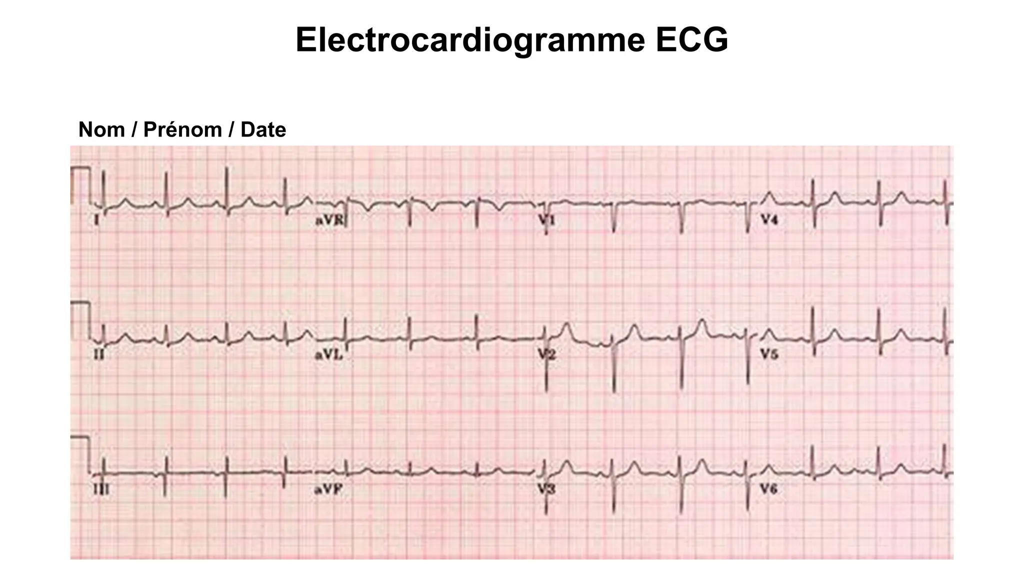 1- Formation ECG TOUBIB World- ECG normal.pptx