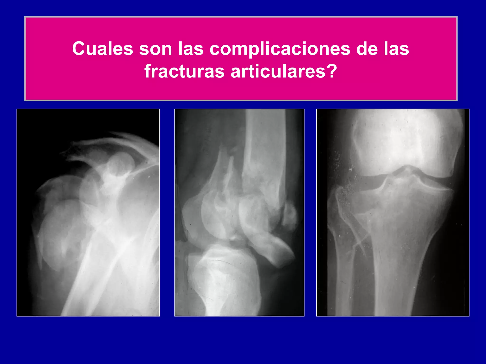 1 fracturas generalidades | PPT