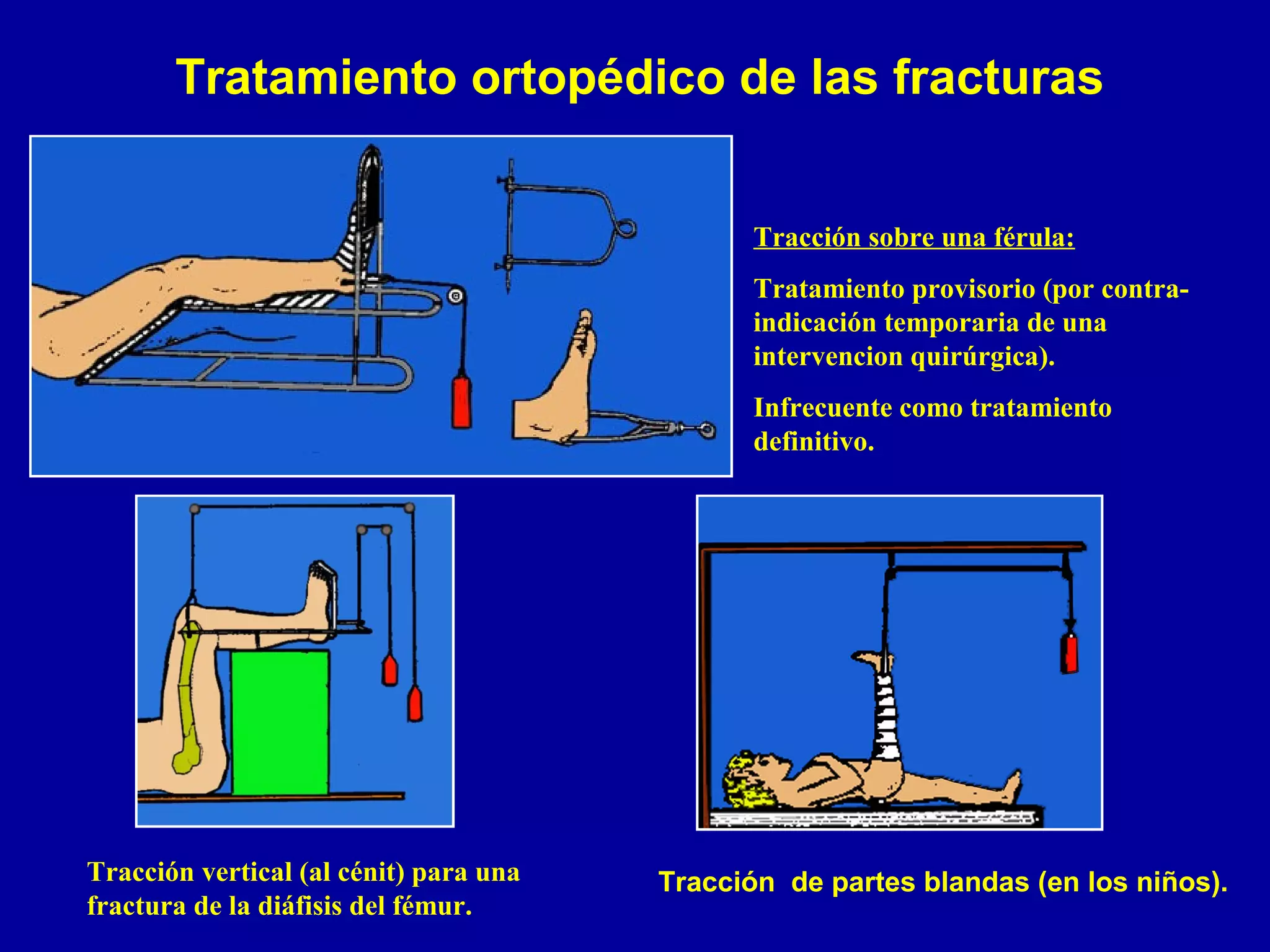 1 fracturas generalidades | PPT