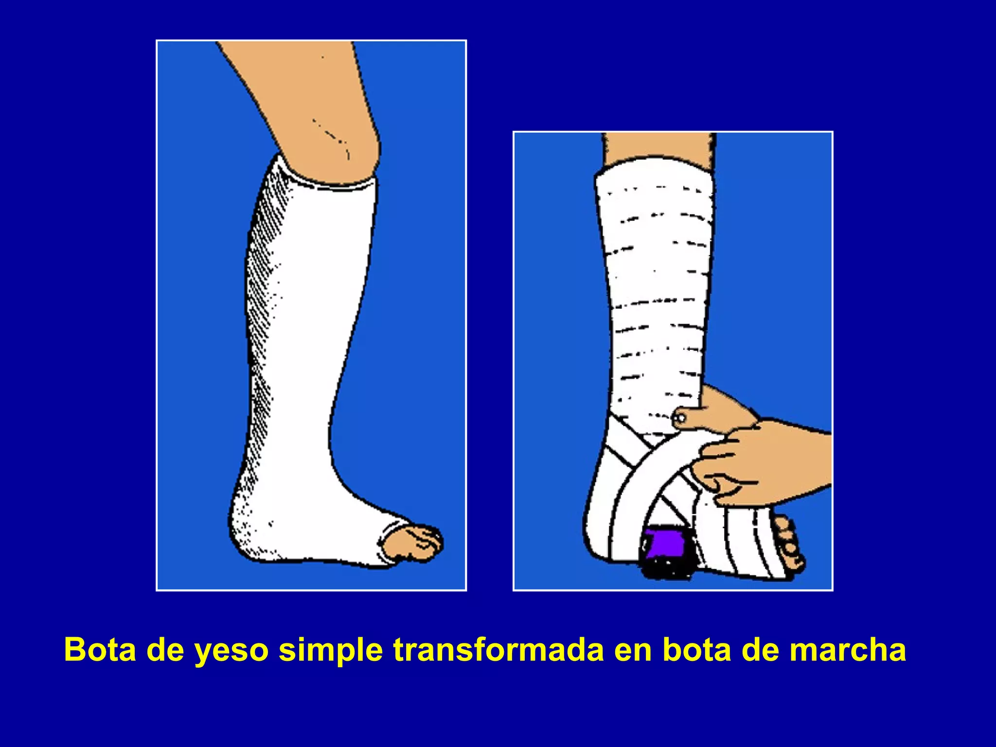 1 fracturas generalidades | PPT