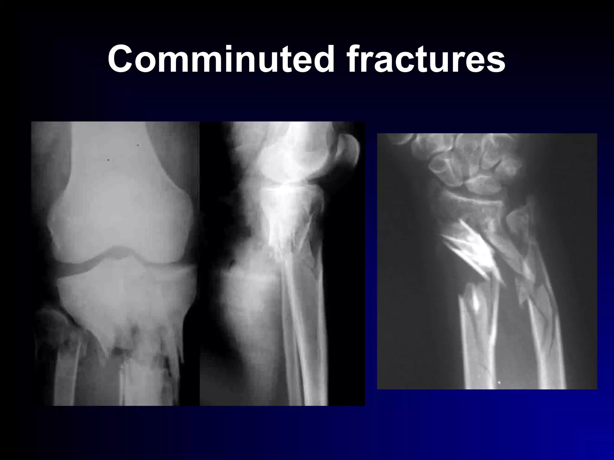 Introduction to Fractures | PPT