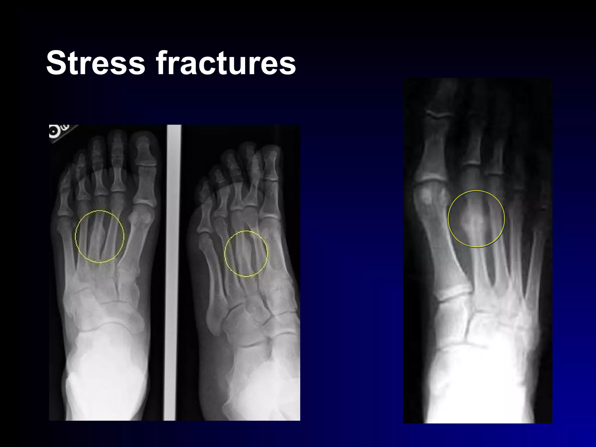 Introduction to Fractures | PPT