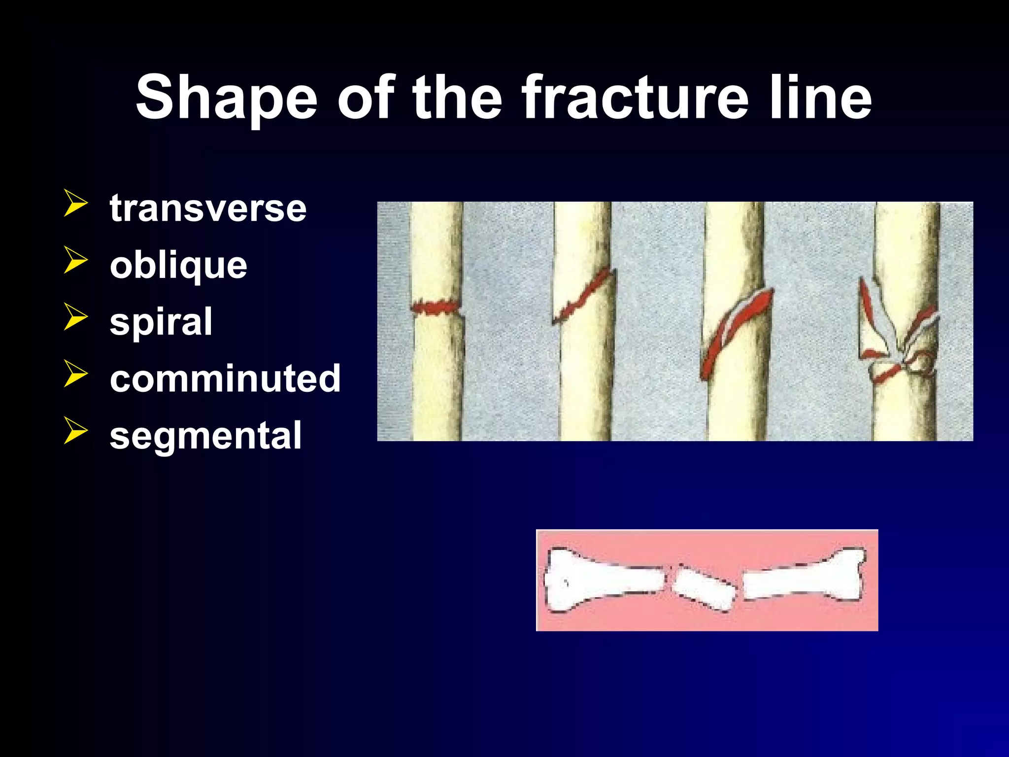 Introduction to Fractures | PPT