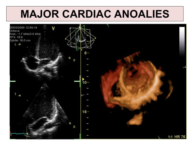 Embryology of heart and understand basic heart disease | PPT