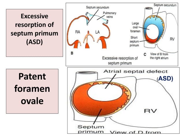 Embryology of heart and understand basic heart disease | PPT