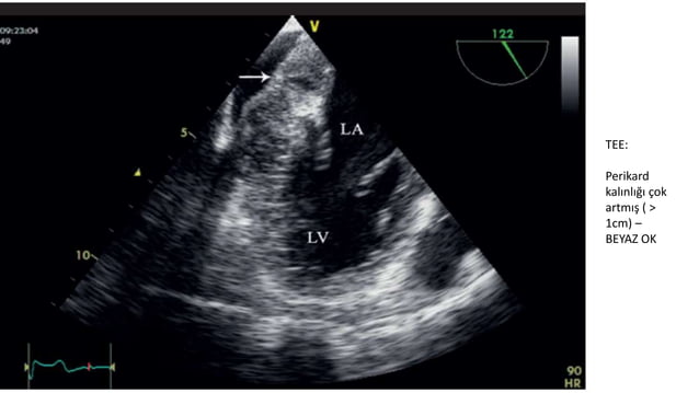 1 hemato-konstriktif perikardit ile gelen nhl vakası | PPT