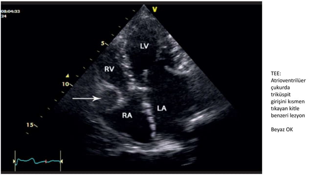 1 hemato-konstriktif perikardit ile gelen nhl vakası | PPT