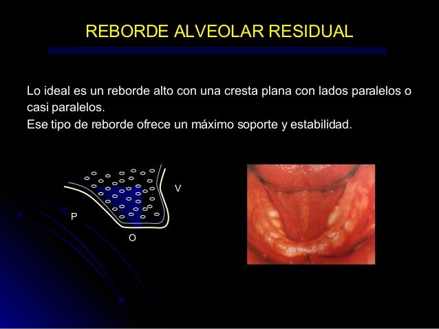Generalidades de Protesis Total