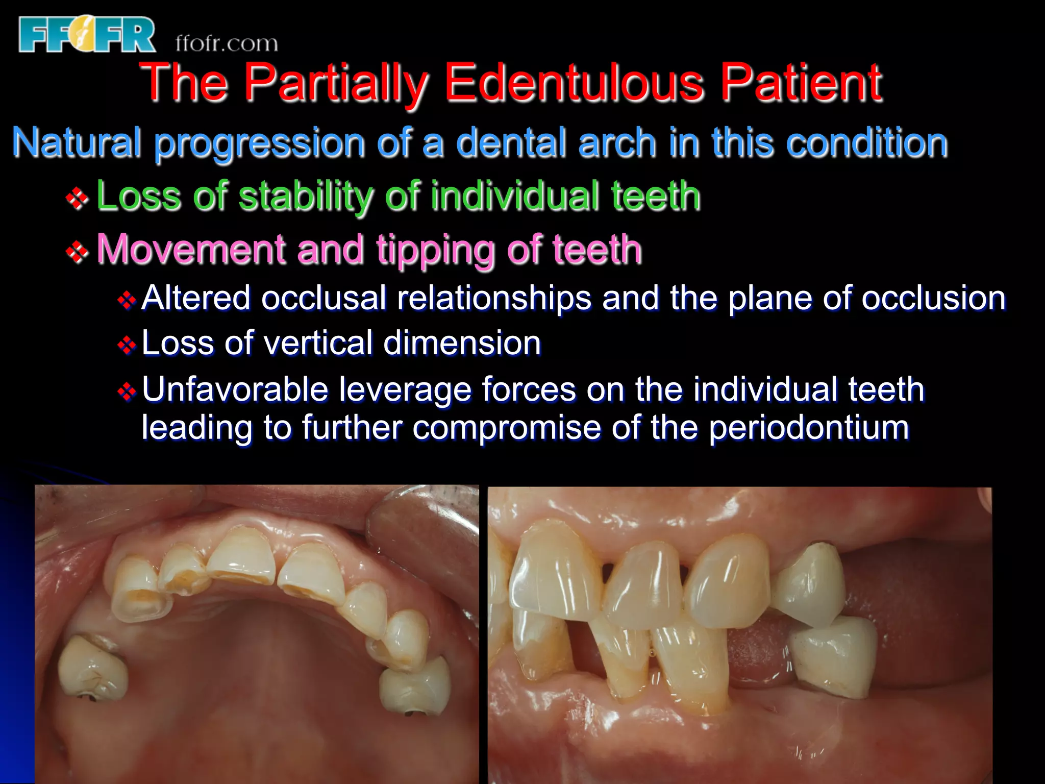 1.introduction and basic components of rpd's copy | PDF | Dental Health ...