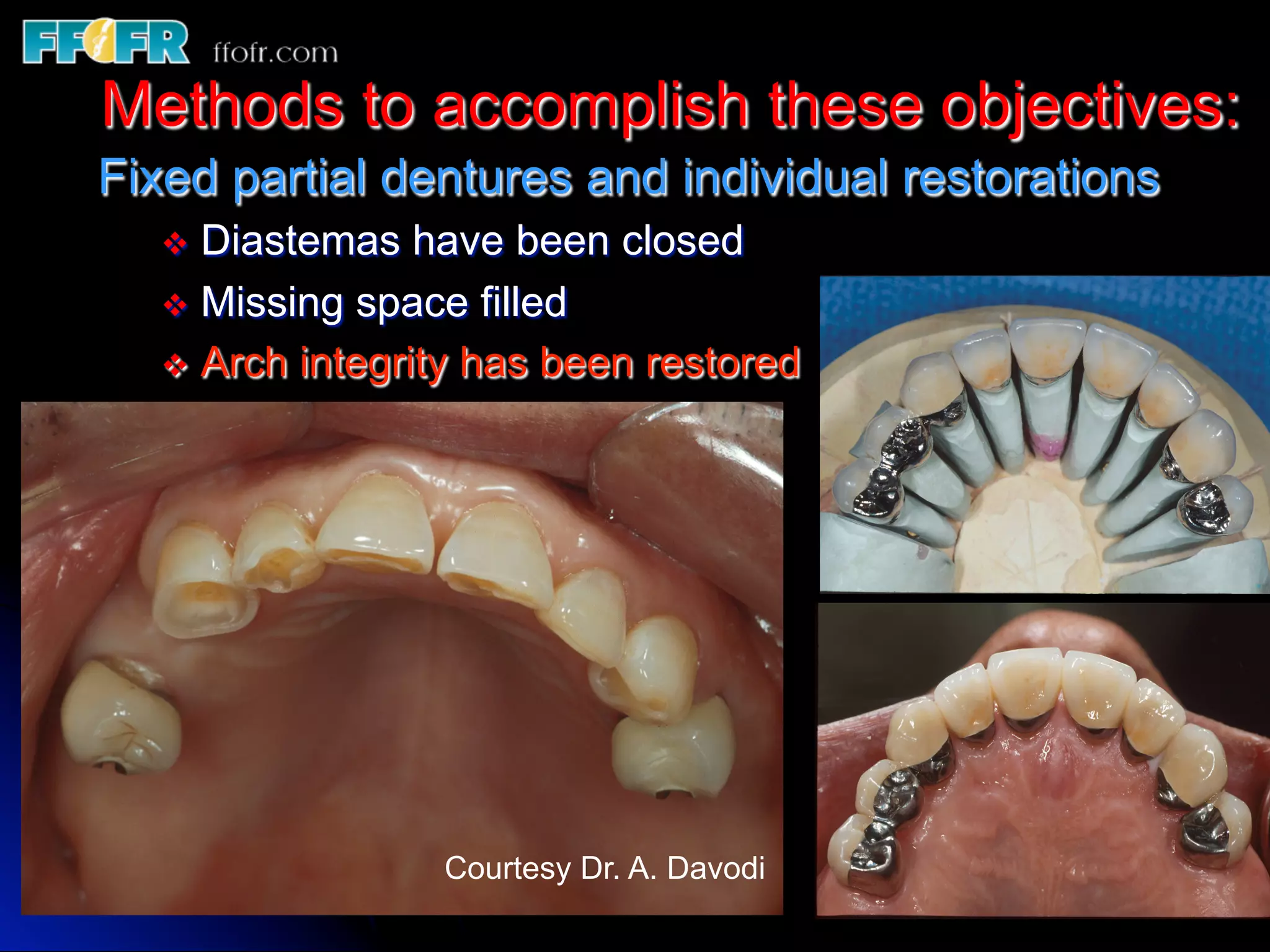 1.introduction and basic components of rpd's copy | PDF | Dental Health ...