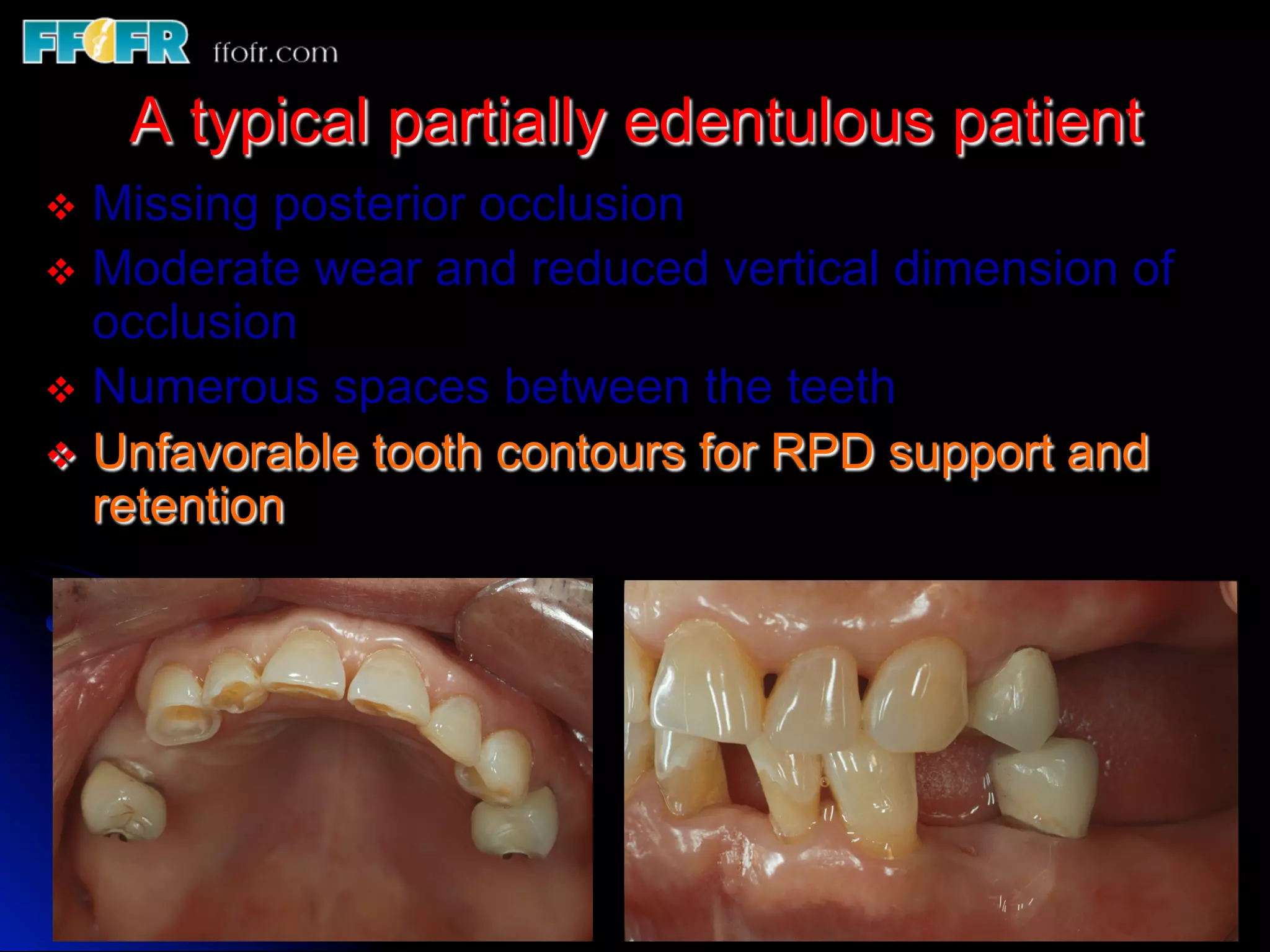 1.introduction and basic components of rpd's copy | PDF | Dental Health ...