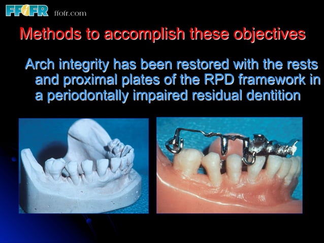 1.introduction and basic components of rpd's copy | PDF | Dental Health ...