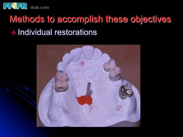 1.introduction and basic components of rpd's copy | PDF | Dental Health ...