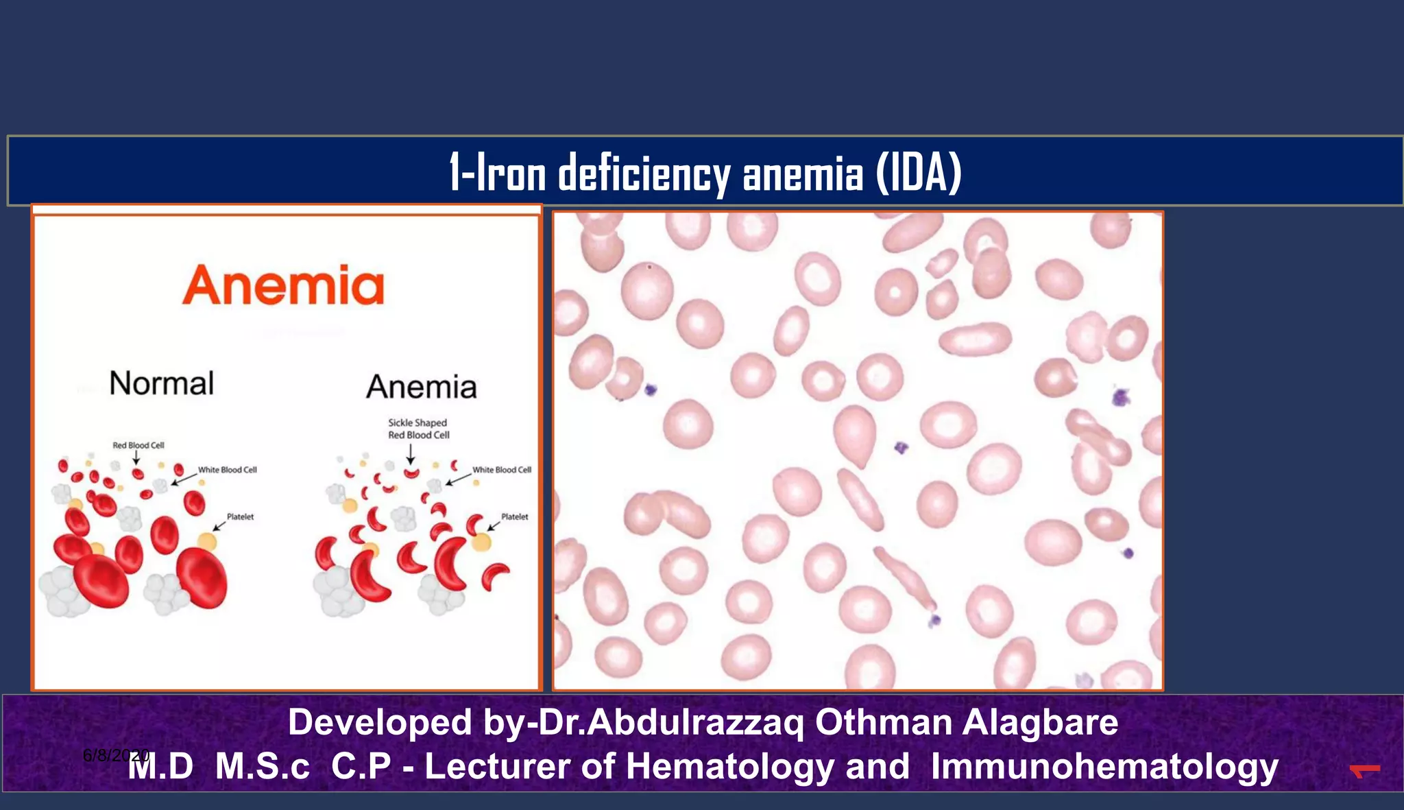 1 iron deficiency anemia (ida) | PDF